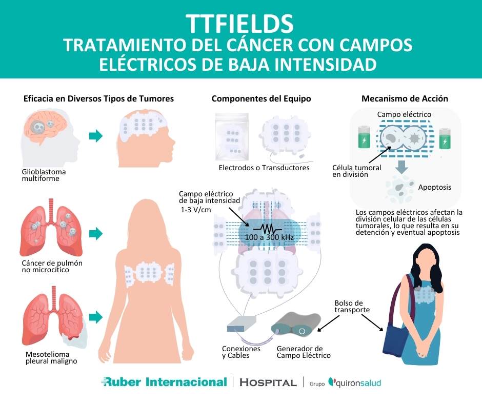 Campos eléctricos (TTFields) en el tratamiento del cáncer